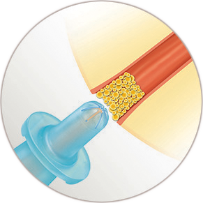 VaPro No Touch Intermittent Catheters | Hollister US